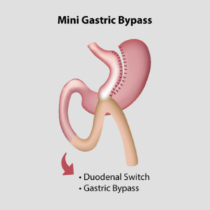 Mini Gastric Bypass Surgery | International Patient Facilitators